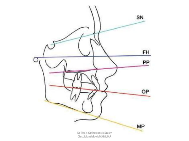Practical cephalometric tracing | PPTX | Dental Health | Diseases and ...