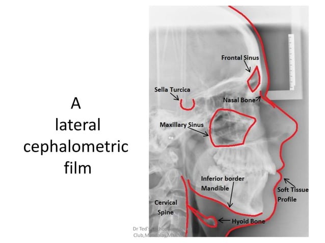 Practical cephalometric tracing | PPTX | Dental Health | Diseases and ...