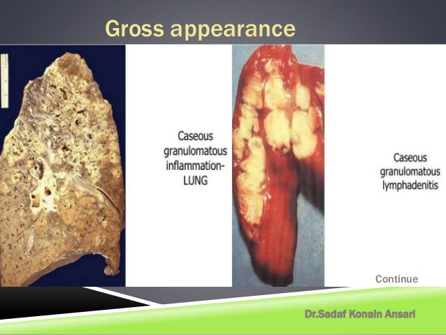 Practical granulomatous inflammation
