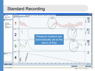 Interpreting toe and ankle pressure curves and results when using ...