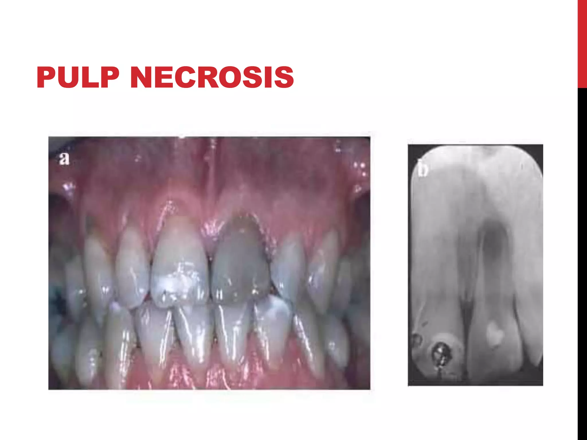 Practical section of pulp and periapical diseases | PPTX
