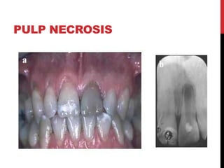 Practical section of pulp and periapical diseases | PPTX