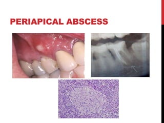 Practical section of pulp and periapical diseases | PPTX