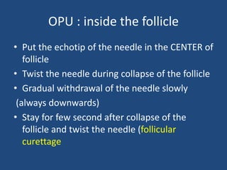 Practical tips for IVF/ET procedure | PPT