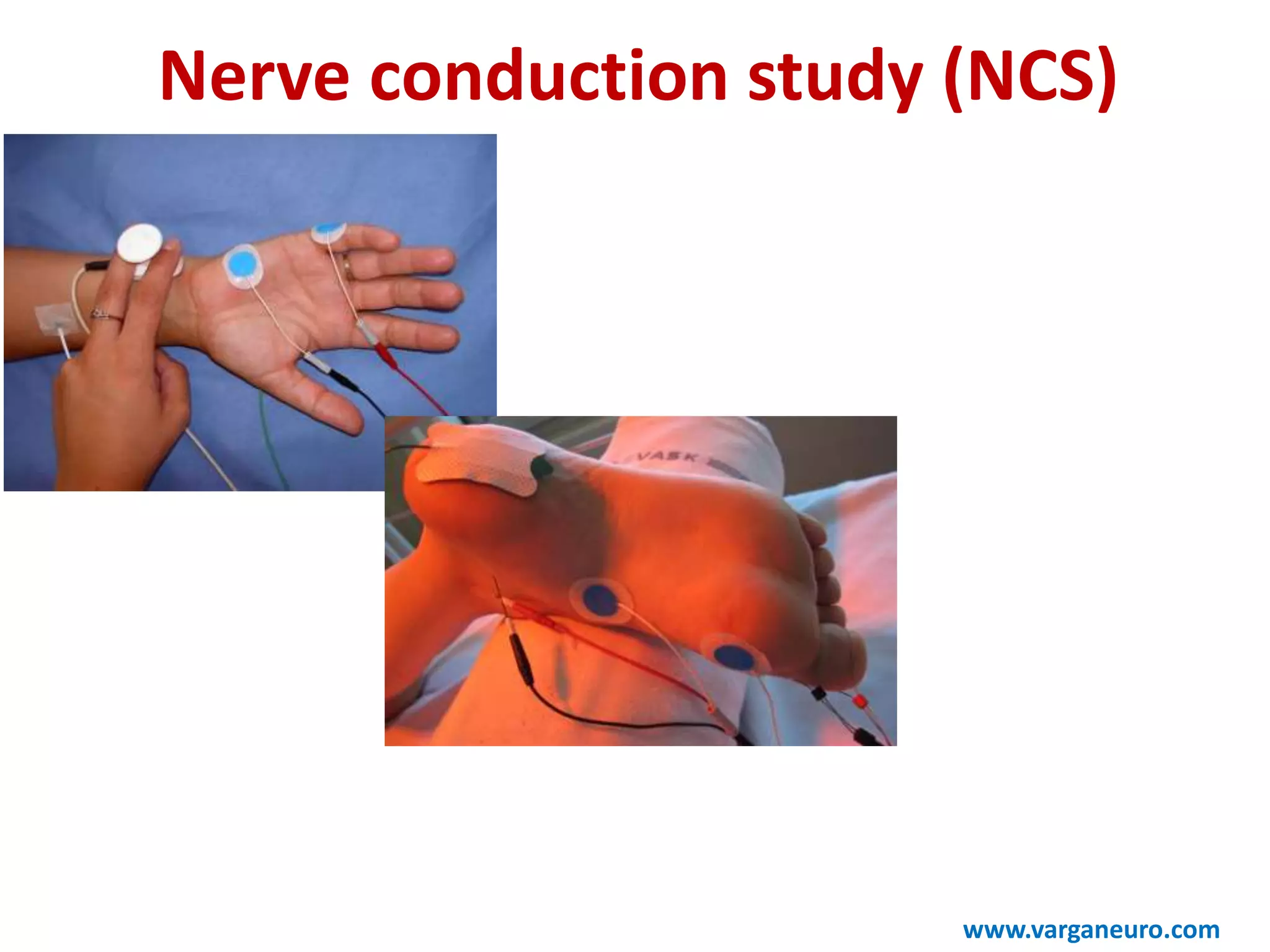 Practical tips for trainees: Nerve conduction studies, near nerve ...