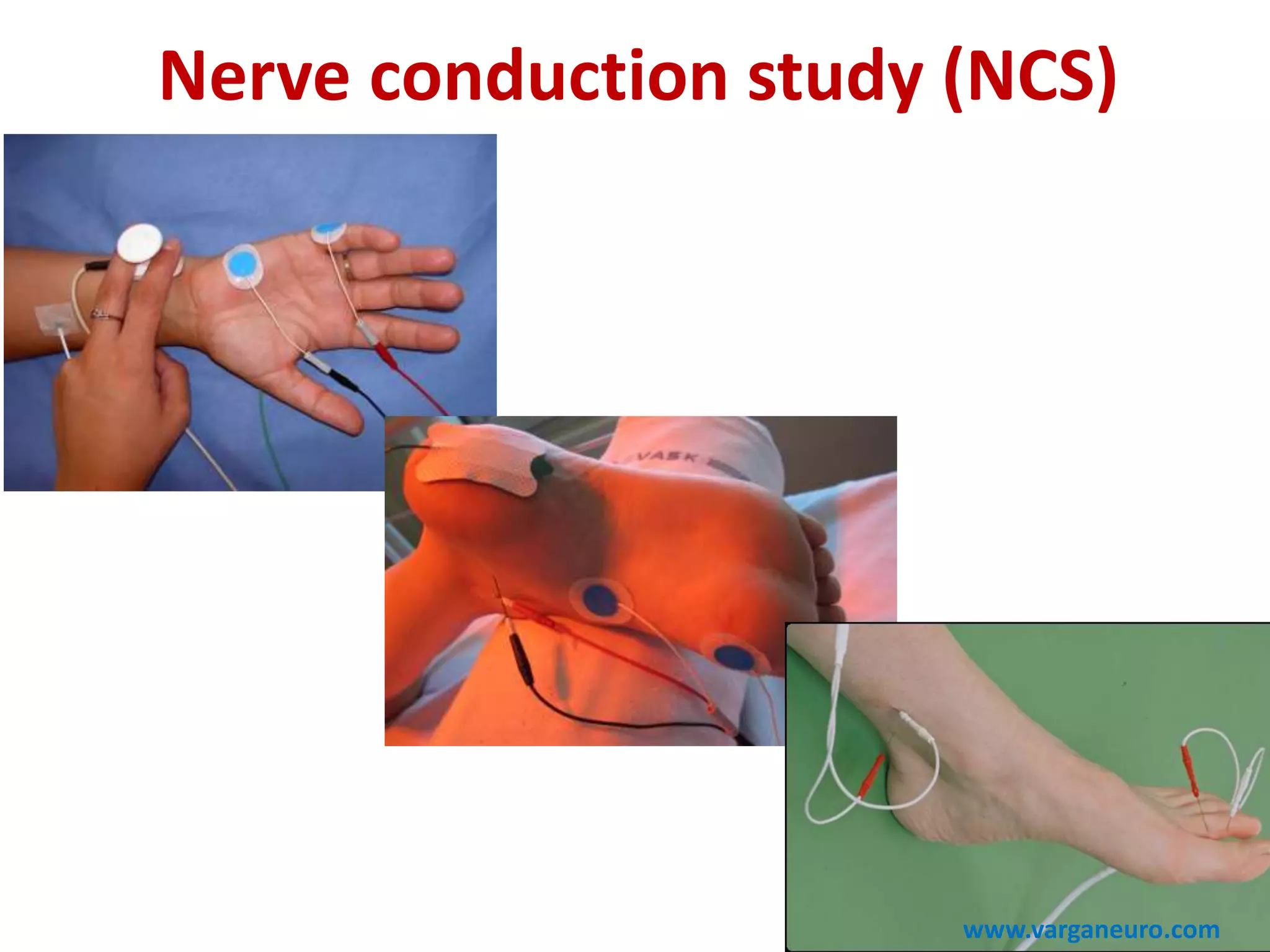 Practical tips for trainees: Nerve conduction studies, near nerve ...