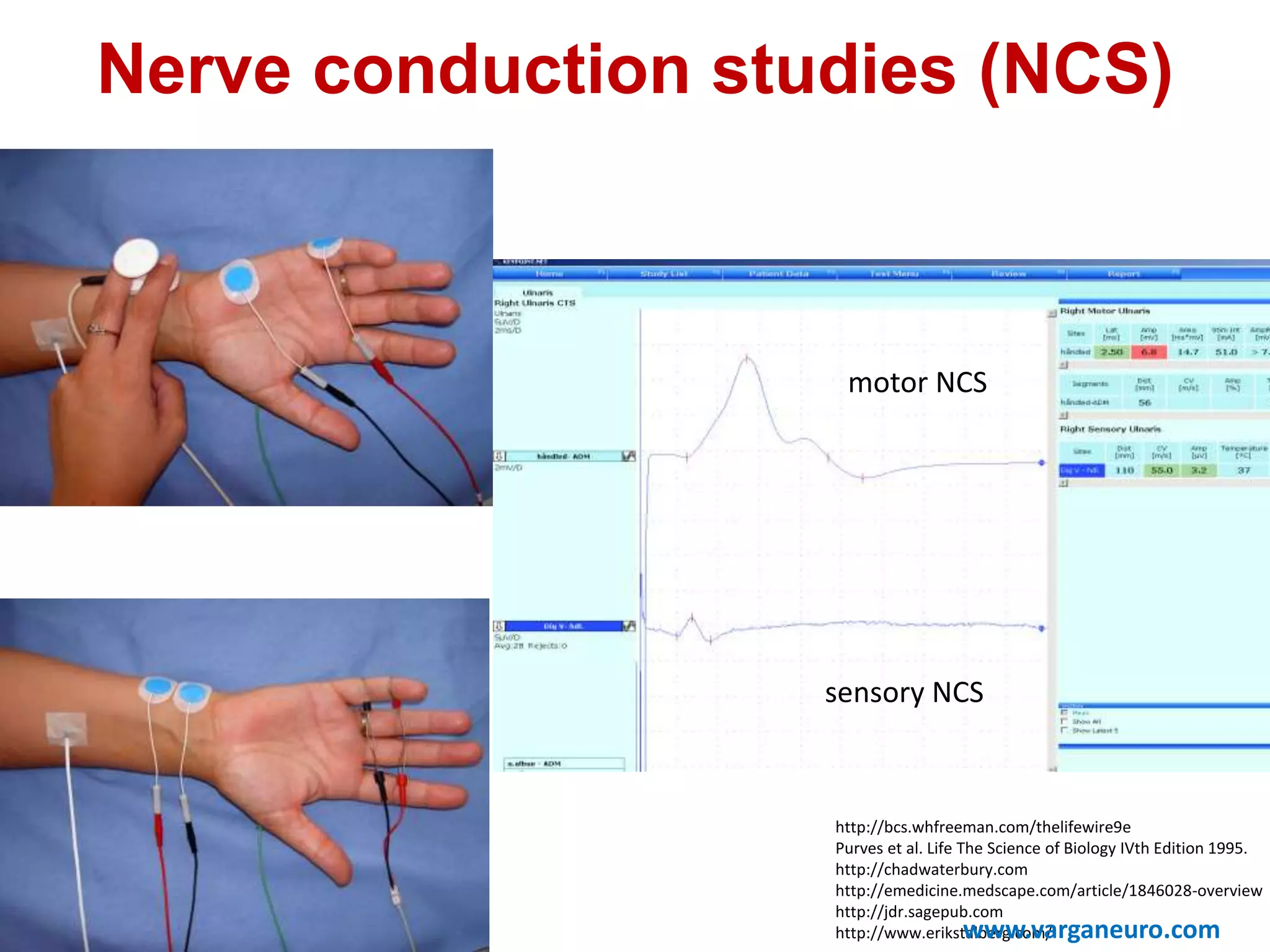 Practical tips for trainees: Nerve conduction studies, near nerve ...