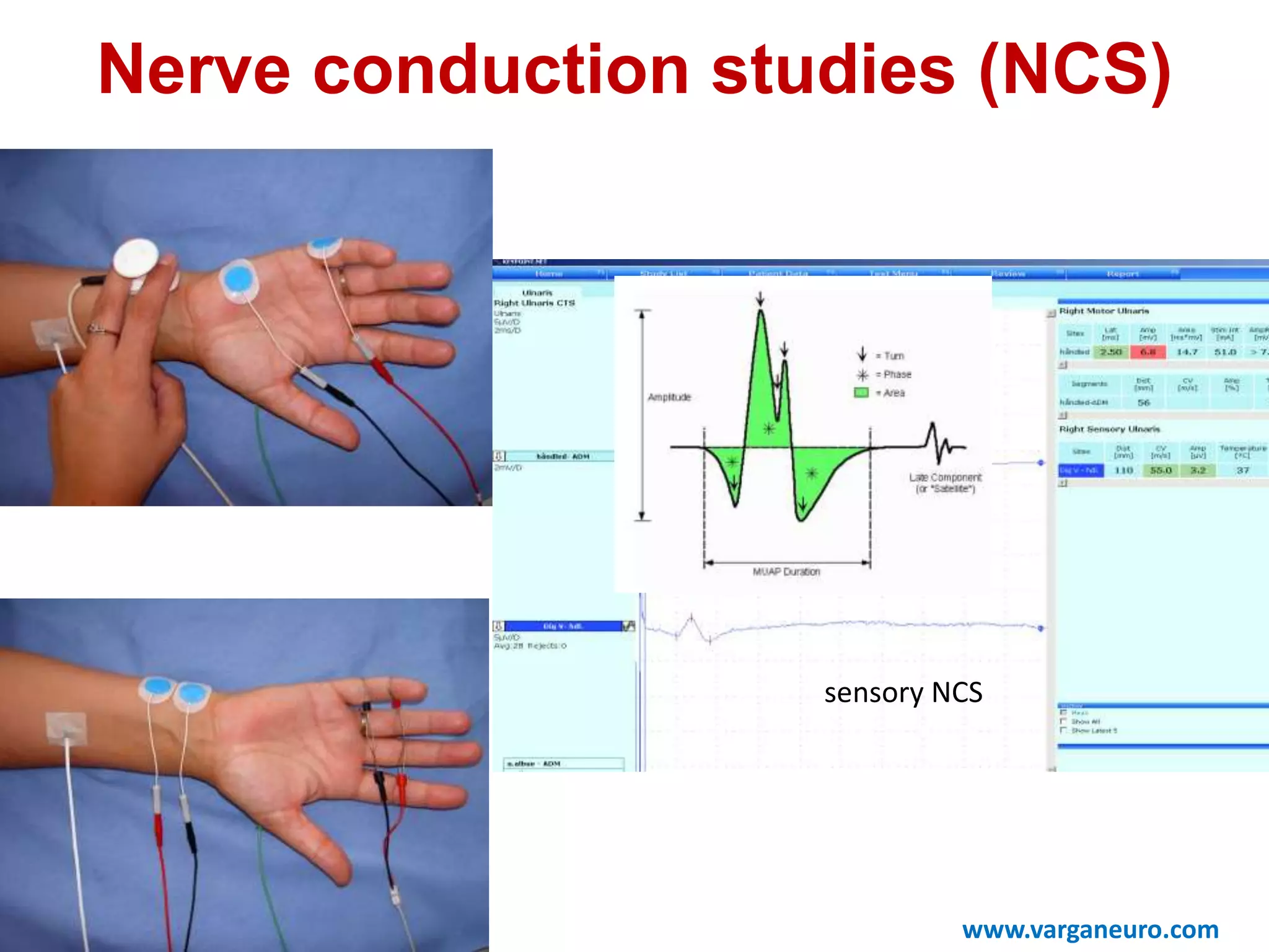 Practical tips for trainees: Nerve conduction studies, near nerve ...