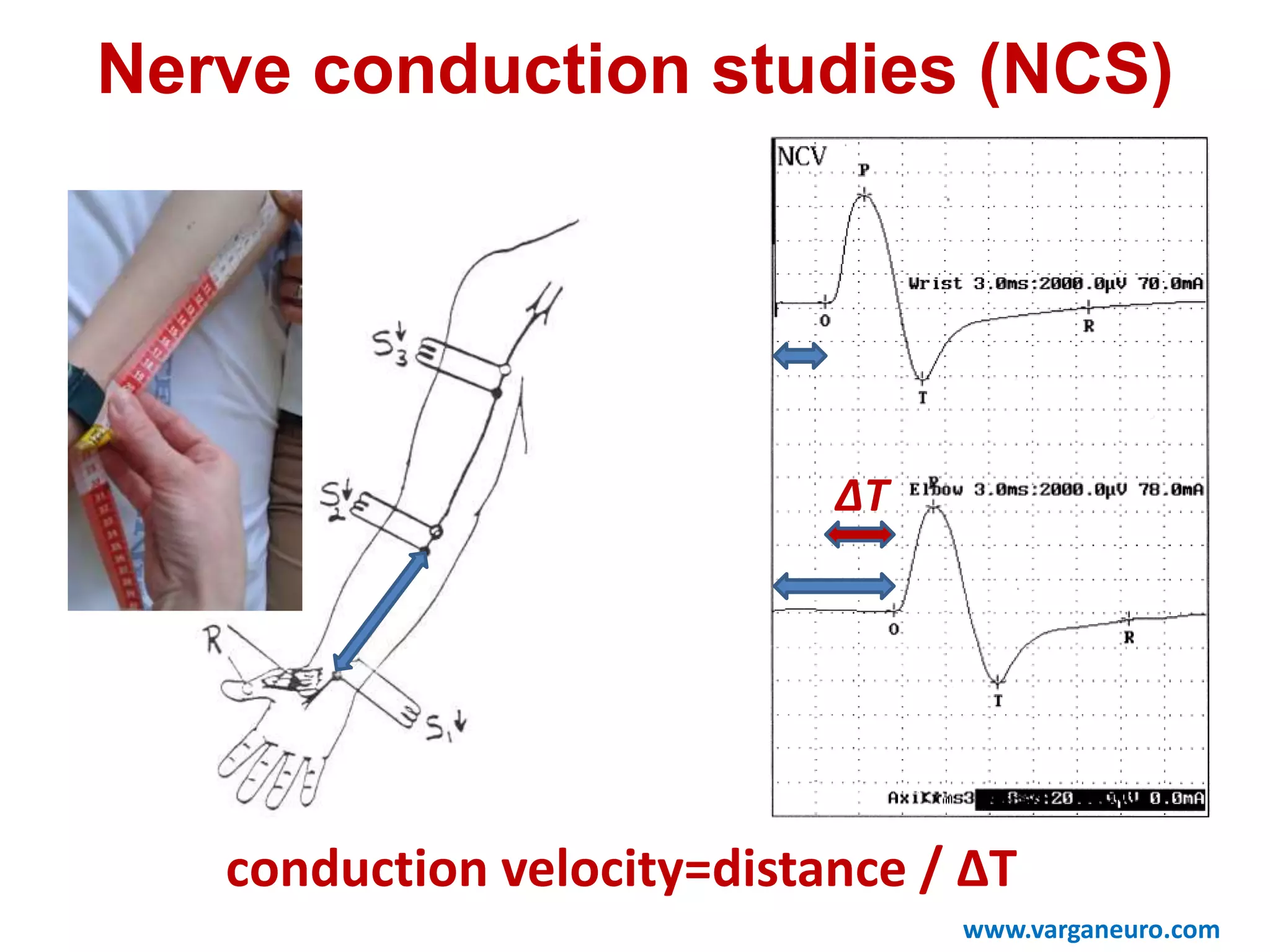 Practical tips for trainees: Nerve conduction studies, near nerve ...