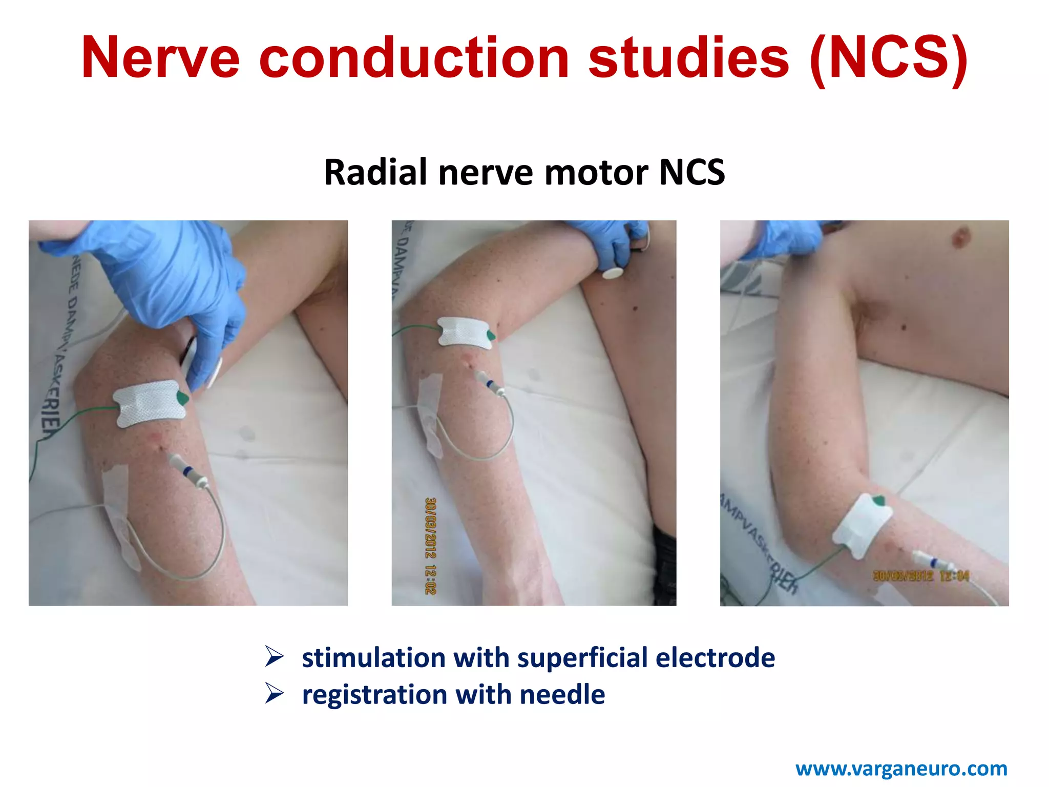 Practical tips for trainees: Nerve conduction studies, near nerve ...