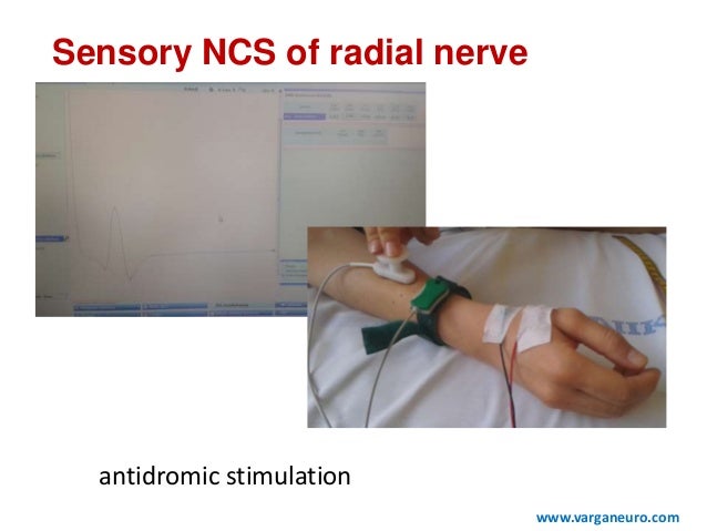 Practical tips for trainees: Nerve conduction studies, near nerve tec…
