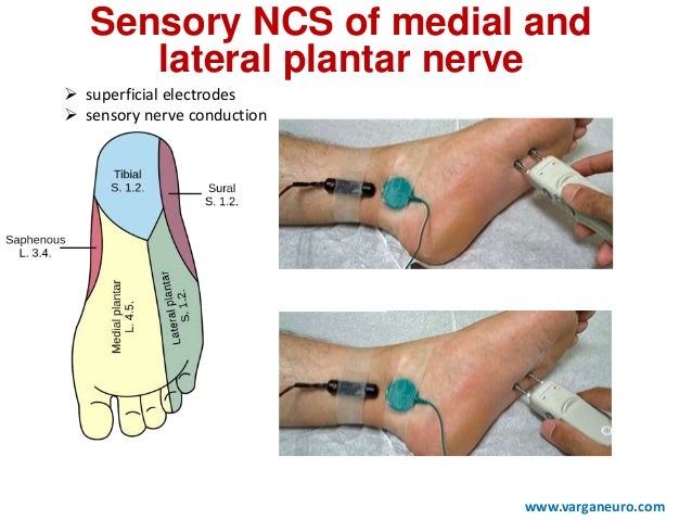 Practical tips for trainees: Nerve conduction studies, near nerve tec…