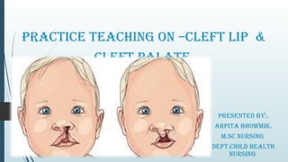 PRACTICE TEACHING ON –Cleft lip & cleft.pptx gastrointerstinal | PPTX