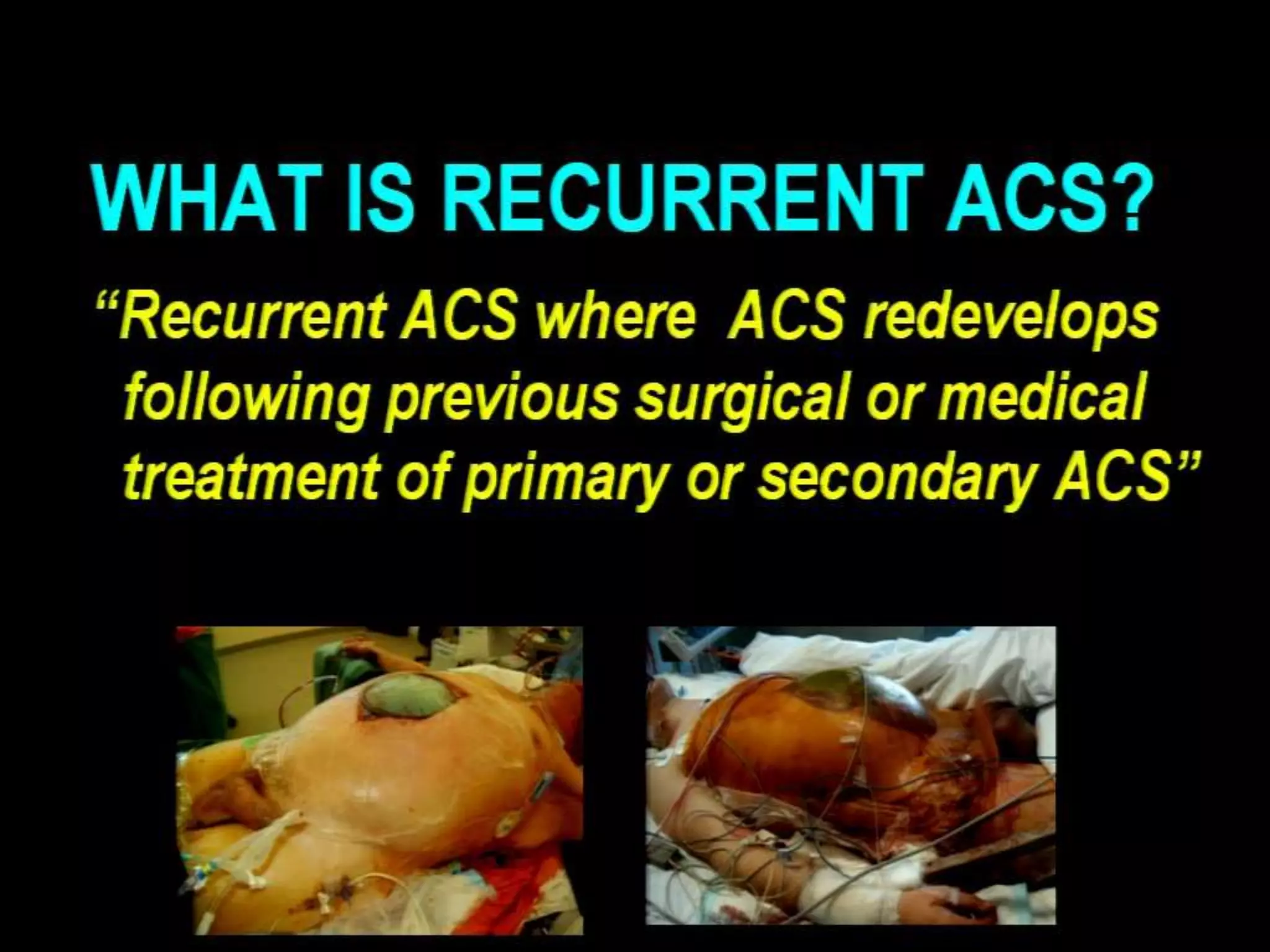 Abdominal Compartment Syndrome | PPTX