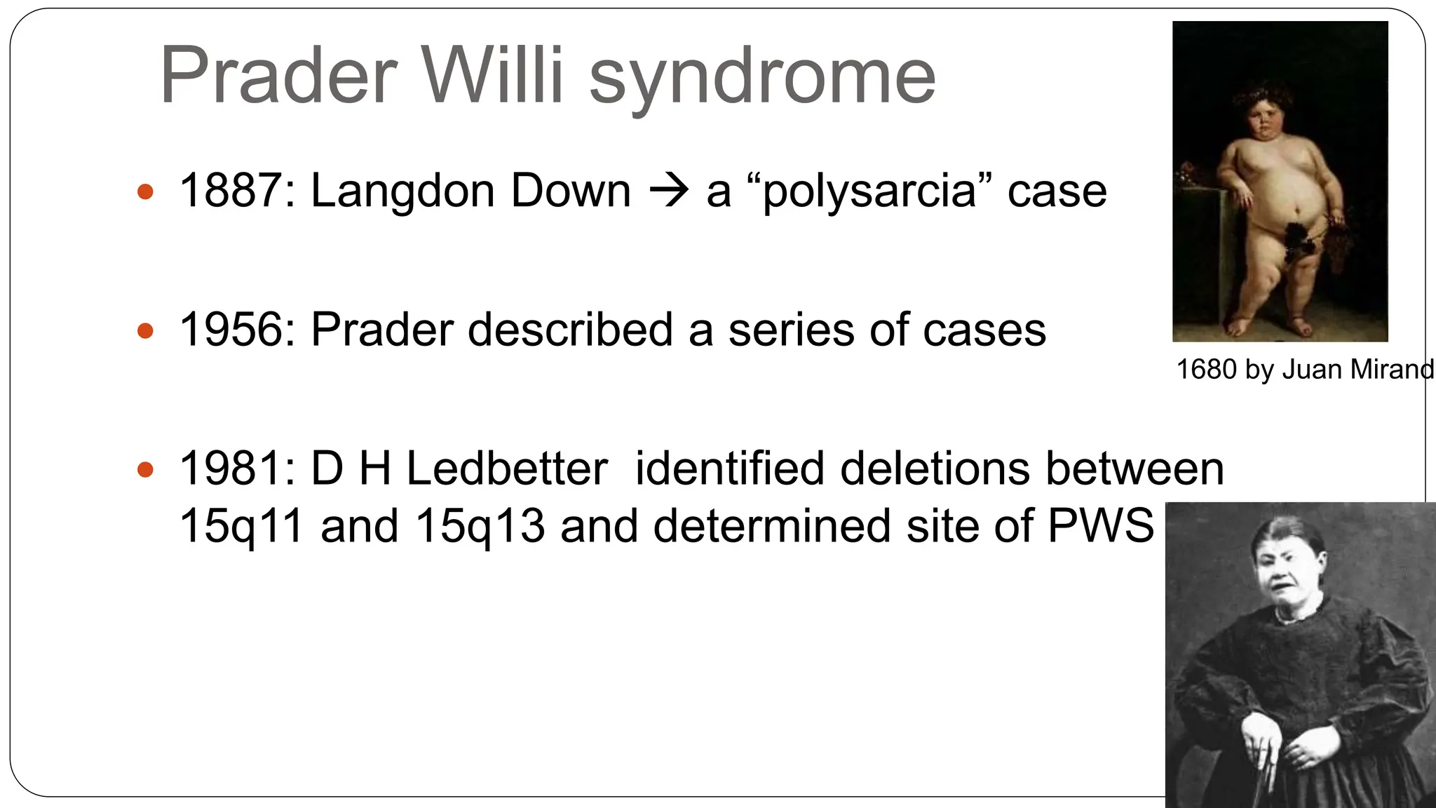 Prader Willi syndrome and Genetics and differentials | PPTX