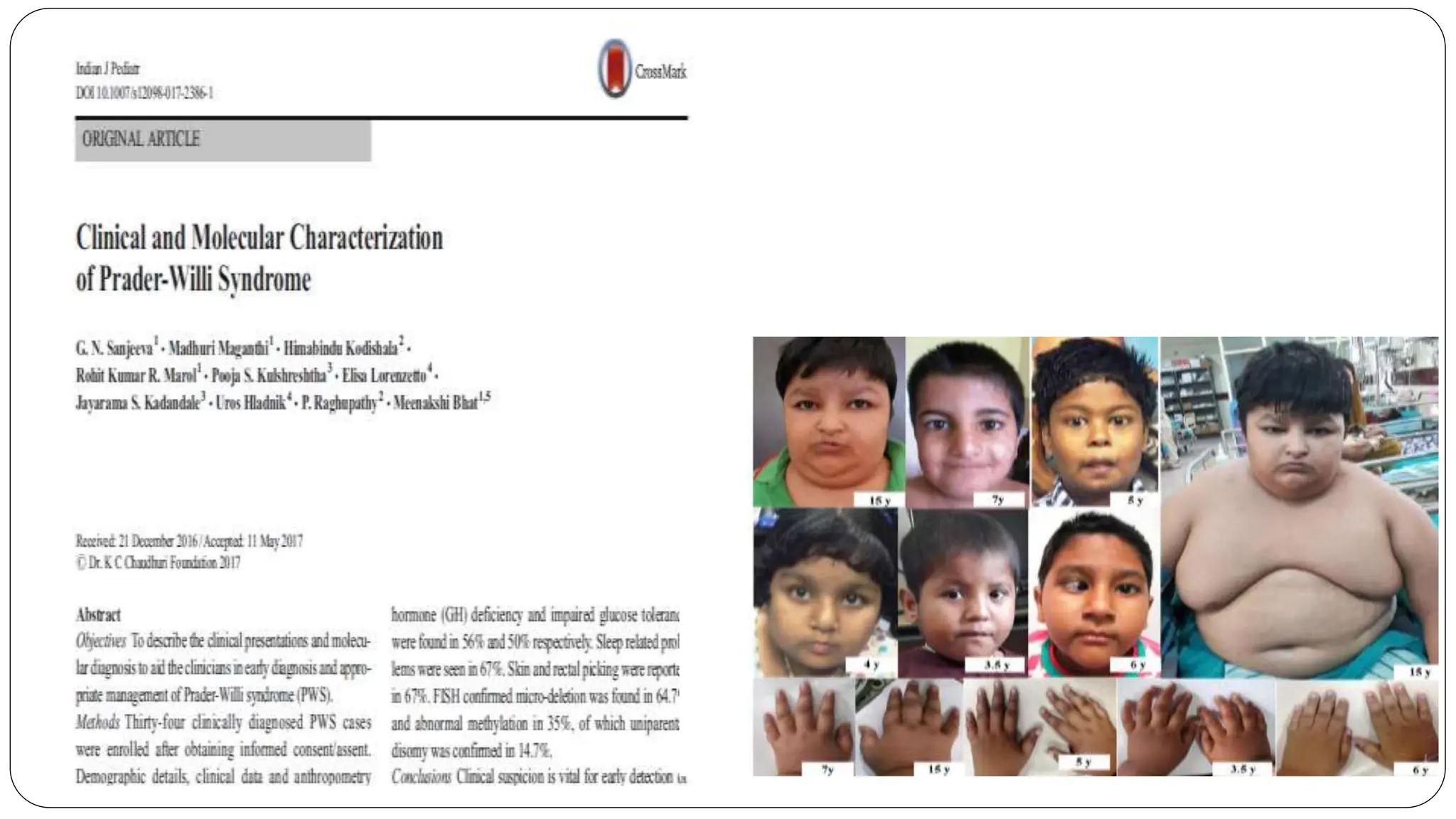 Prader Willi syndrome and Genetics and differentials | PPTX