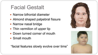Prader Willi syndrome and Genetics and differentials | PPTX