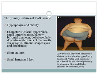 Prader willi | PDF