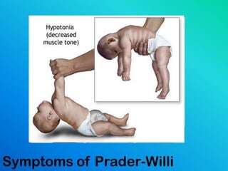 Prader willis Syndrome | PPTX
