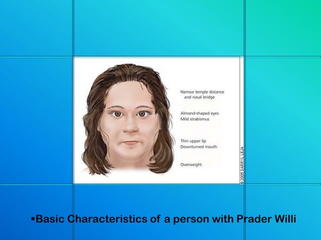 Prader willis Syndrome | PPTX
