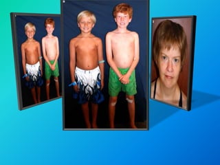 Prader willis Syndrome | PPTX
