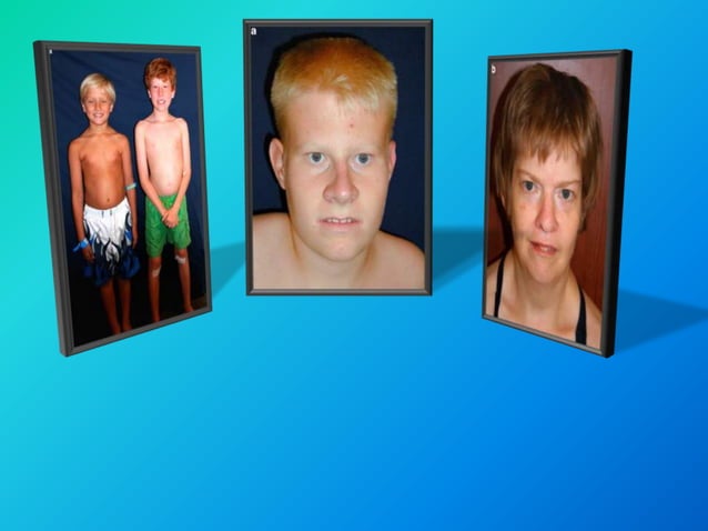 Prader willis Syndrome | PPTX
