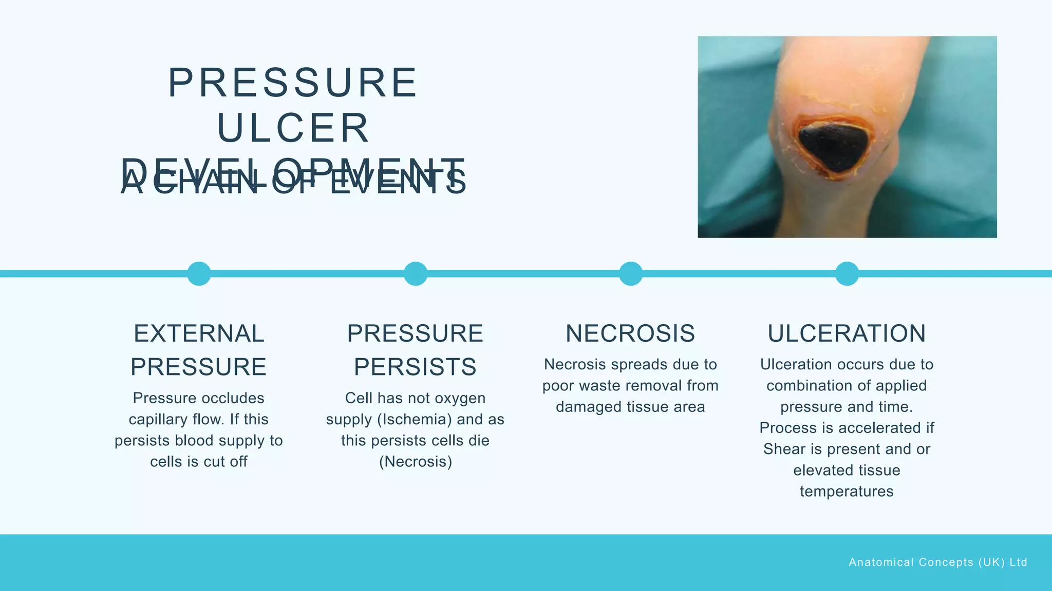 Prevention of Heel Pressure Ulcers | PPT