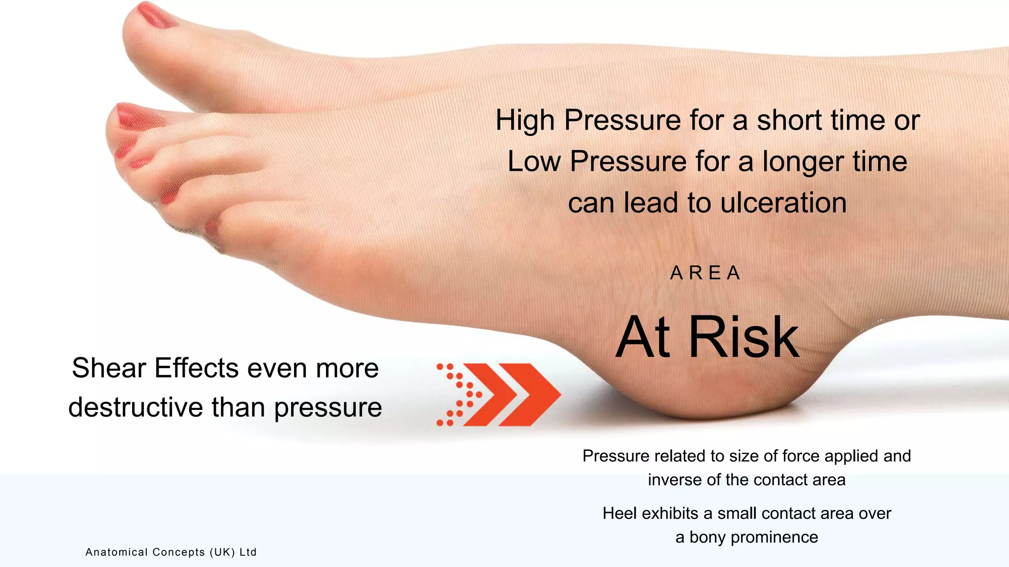 Prevention of Heel Pressure Ulcers | PPT