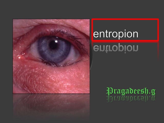 ENTROPION | PPTX