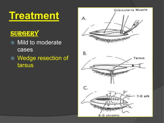 How Is Entropion Treated