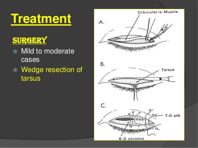 Entropion And Ectropion Causes Symptoms And Treatment Entropion And
