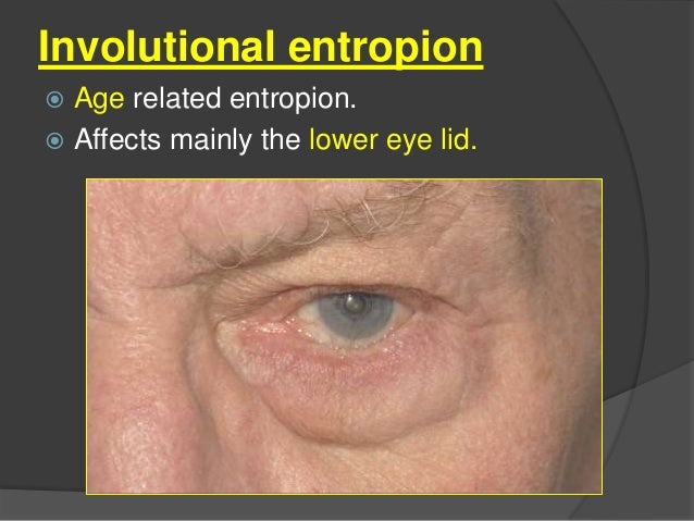 Involutional Entropion