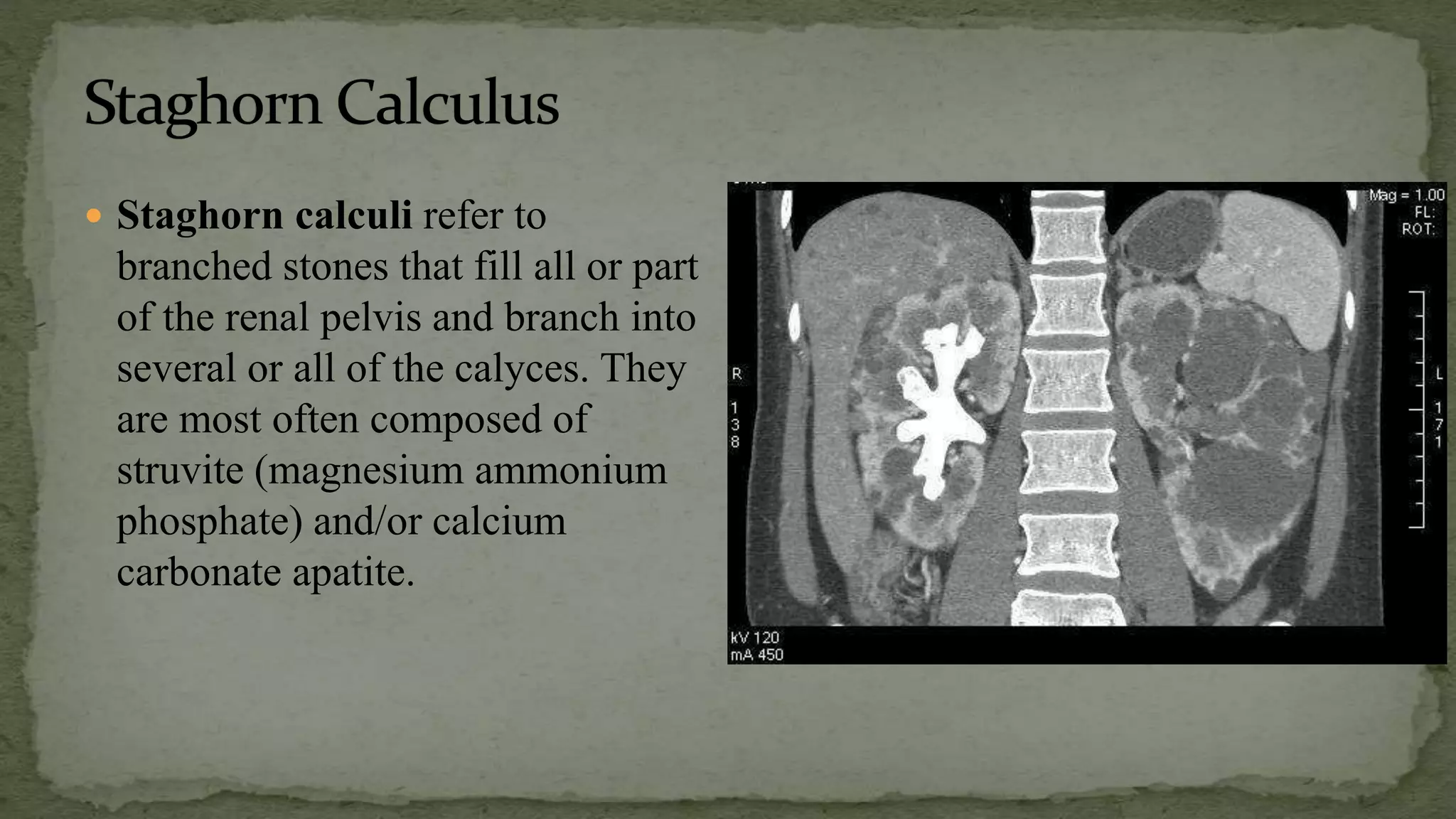 Renal Calculus | PPTX