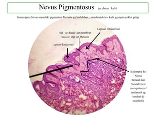 Praktikum Patologi Anatomi BLOK 20 Integumen (Kulit) | PDF