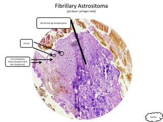 Praktikum Patologi Anatomi Blok Neurologi | PDF