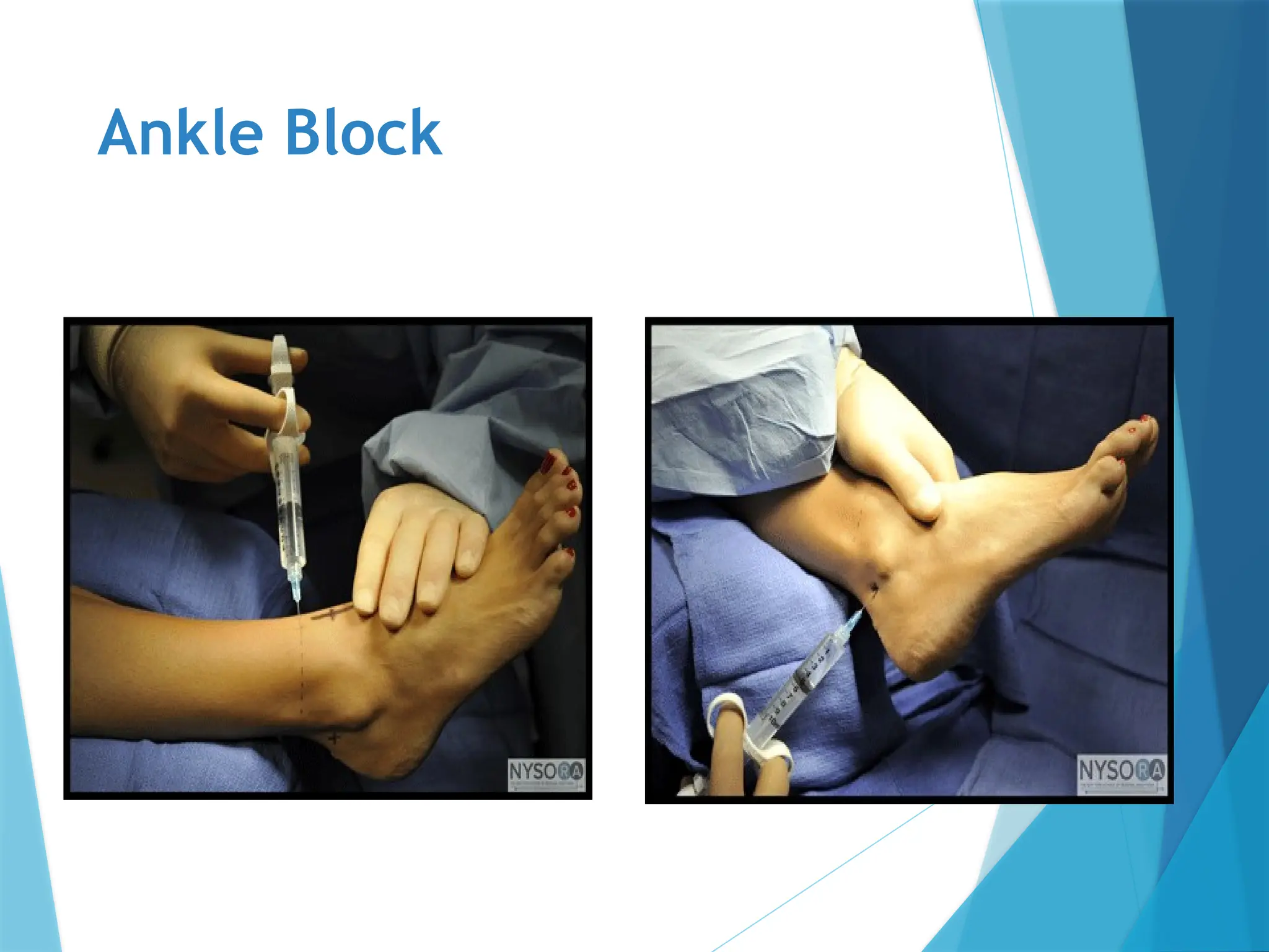 prameela peripheral nerve blocks anatomy and physiology considerations ...