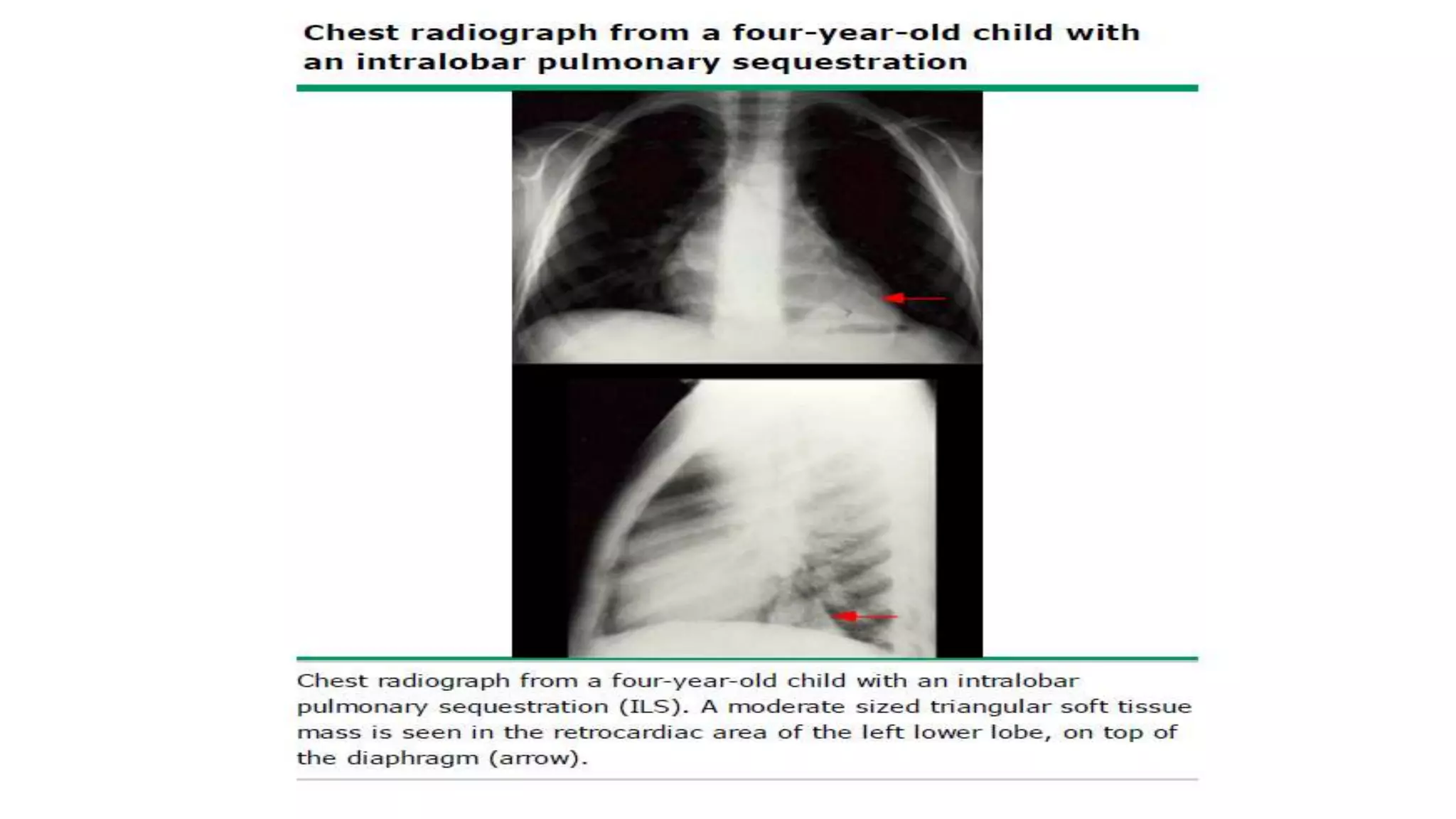 Pulmonary sequestration ppt | PPTX