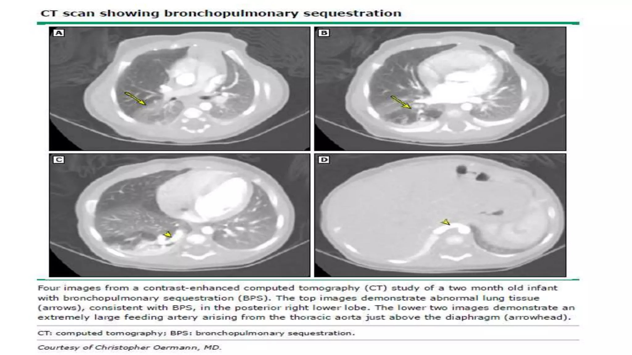 Pulmonary sequestration ppt | PPTX