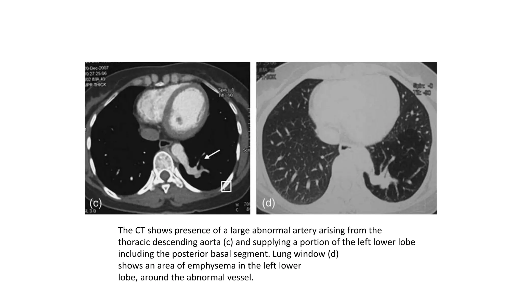 Pulmonary sequestration ppt | PPTX