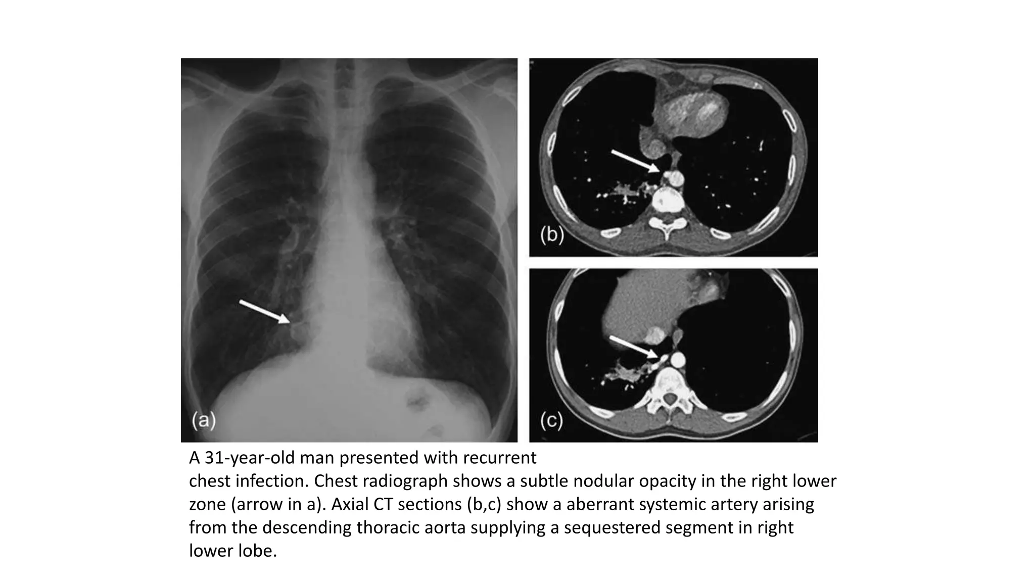 Pulmonary sequestration ppt | PPTX