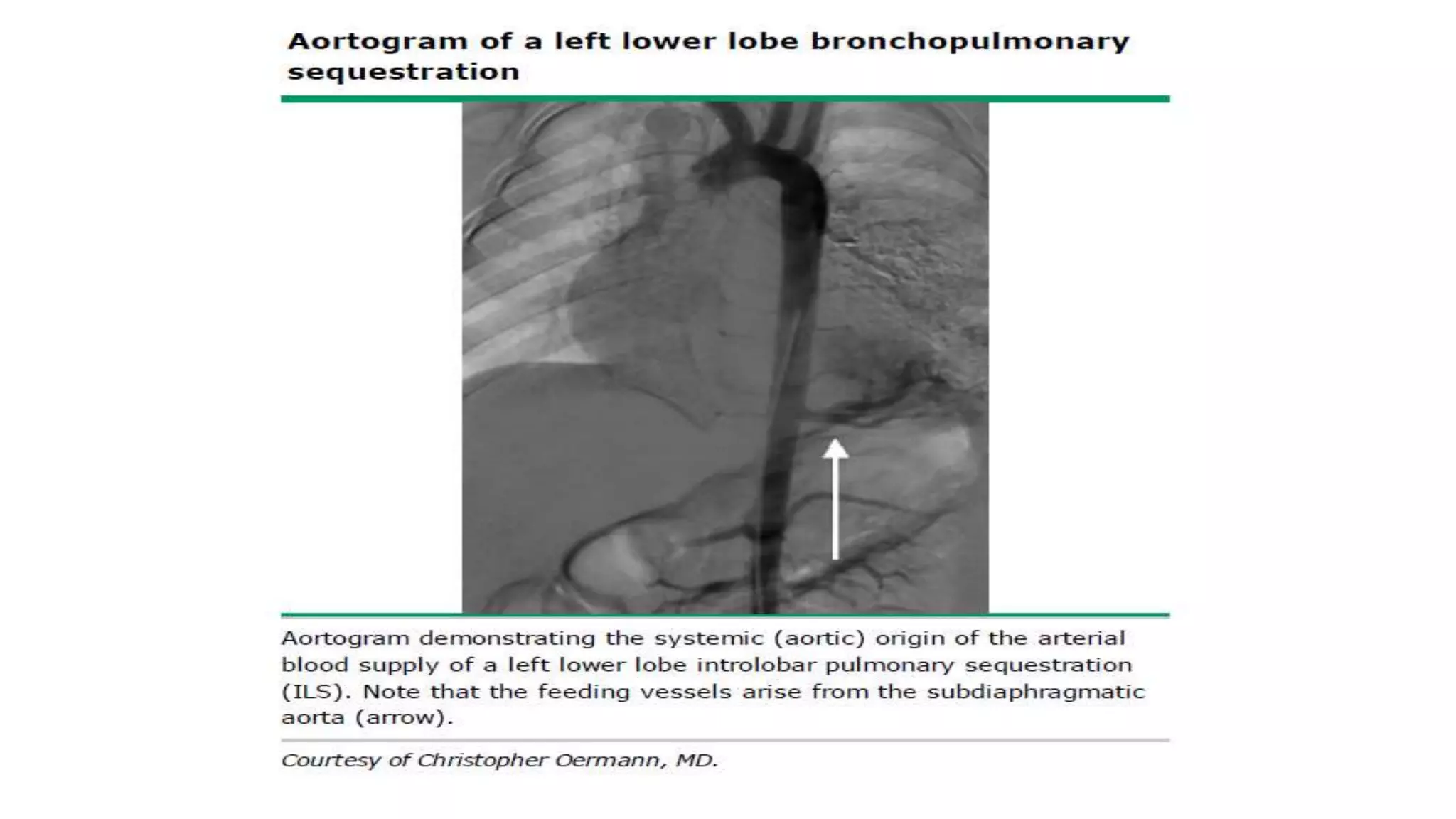 Pulmonary sequestration ppt | PPTX