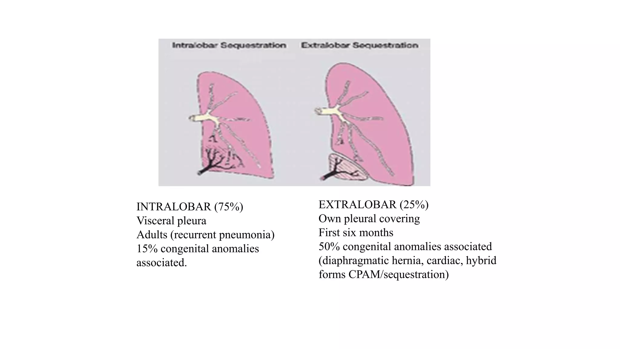 Pulmonary sequestration ppt | PPTX