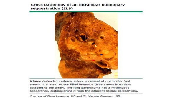 Pulmonary sequestration ppt | PPTX
