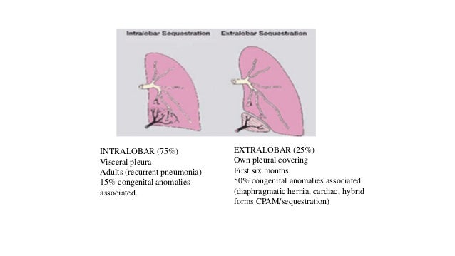 Pulmonary sequestration ppt