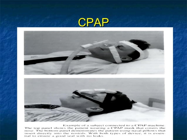 Obstructive Sleep Apnoea: Diagnosis, Criteria, Management | PPT | Lung ...