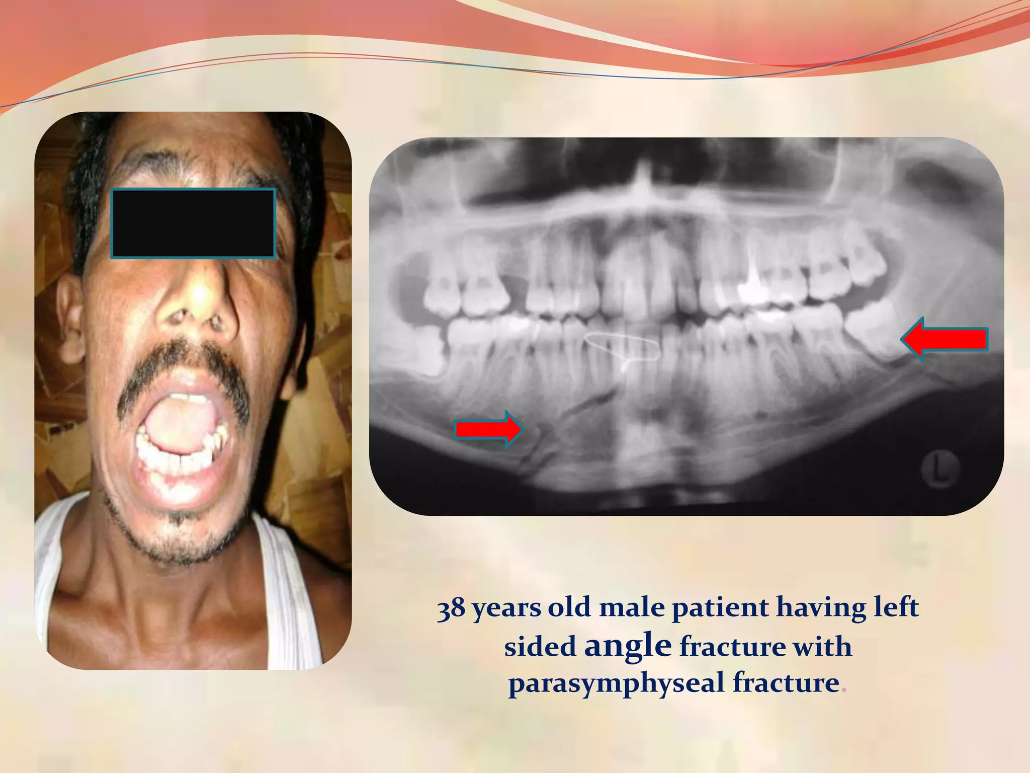 Mandibular Fracture Types & Management | PPTX