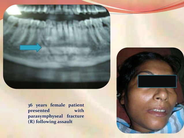 Mandibular Fracture Types & Management | PPT