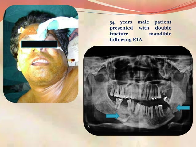 Mandibular Fracture Types & Management | PPT