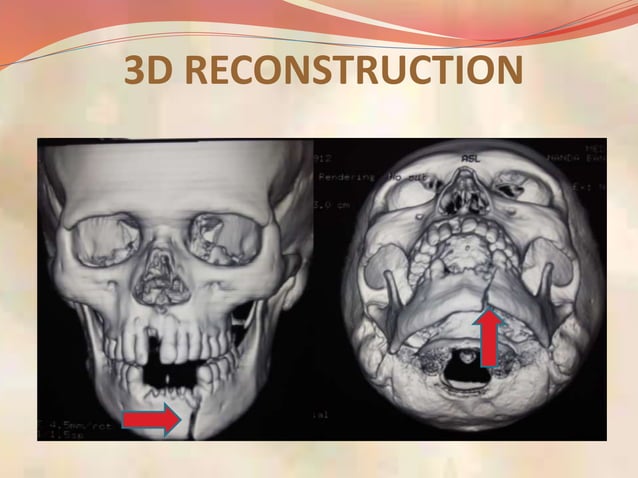 Mandibular Fracture Types & Management | PPT