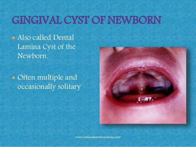 CYSTS vAND CYST LIKE LESIONS vOF THE JAWS /prosthodontic courses